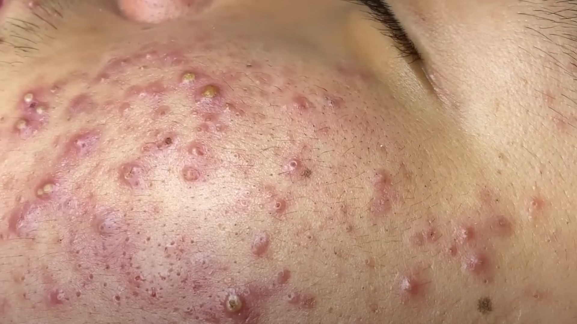 Cystic Acne | Pimple.tv | The Best Pimple Popping 2021 Videos You'll Find on the Internet